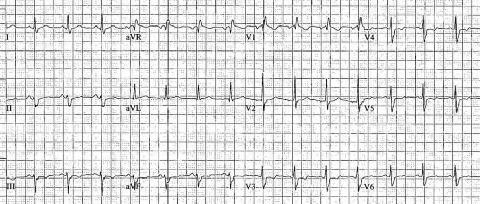 EM Cases | ECG cases 12: RBBB + Occlusion MI