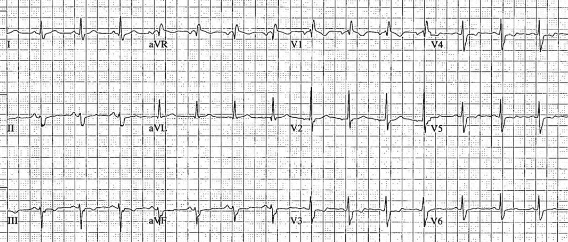 Casos EM | Casos de ECG 12: BRD + Oclusión IM - blogfarmaceutico.com