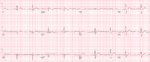EM Cases | ECG cases 12: RBBB + Occlusion MI