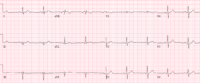 EM Cases | ECG cases 12: RBBB + Occlusion MI