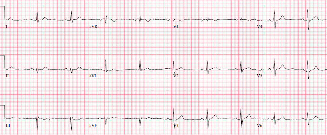 EM Cases | ECG cases 12: RBBB + Occlusion MI