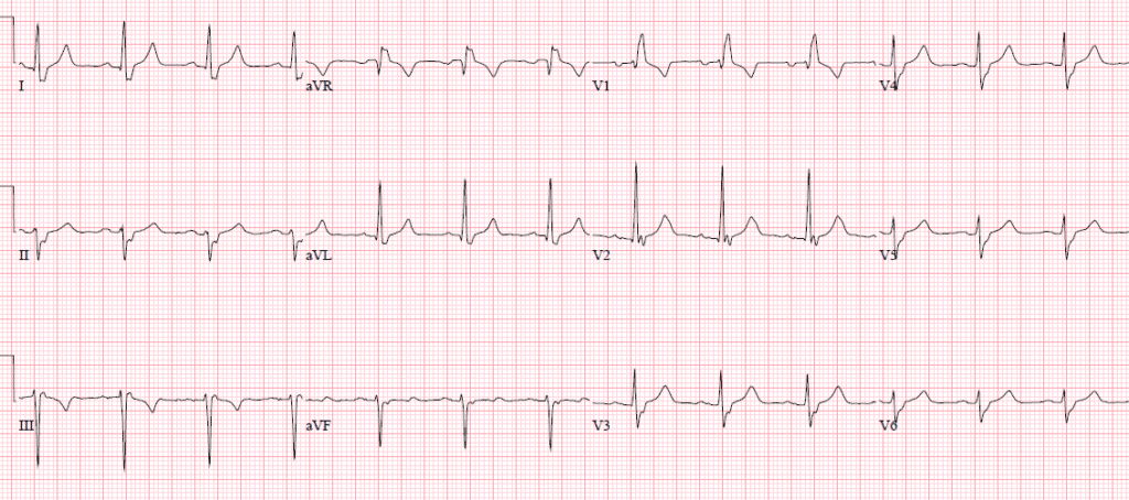 EM Cases | ECG cases 12: RBBB + Occlusion MI
