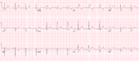 EM Cases | ECG cases 12: RBBB + Occlusion MI