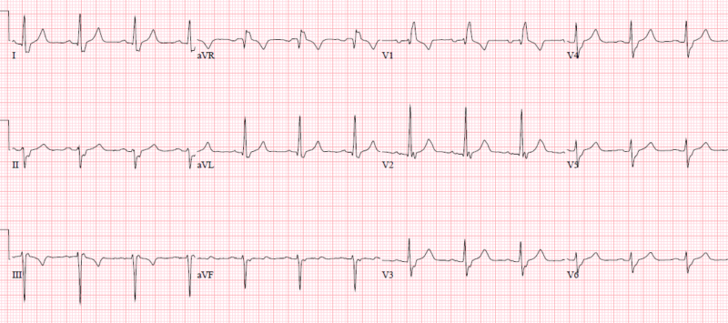 EM Cases | ECG cases 12: RBBB + Occlusion MI