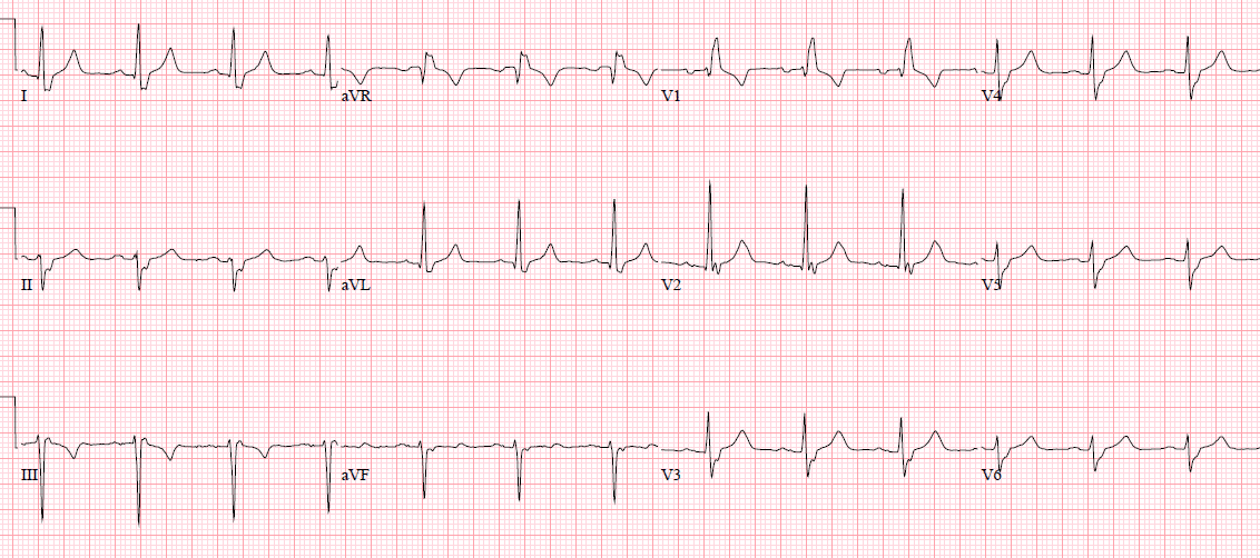 EM Cases | ECG cases 12: RBBB + Occlusion MI