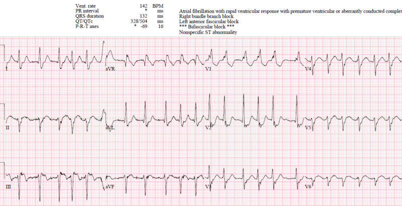 EM Cases | ECG cases 12: RBBB + Occlusion MI