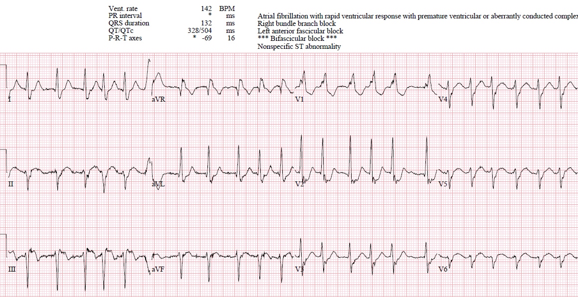 EM Cases | ECG cases 12: RBBB + Occlusion MI