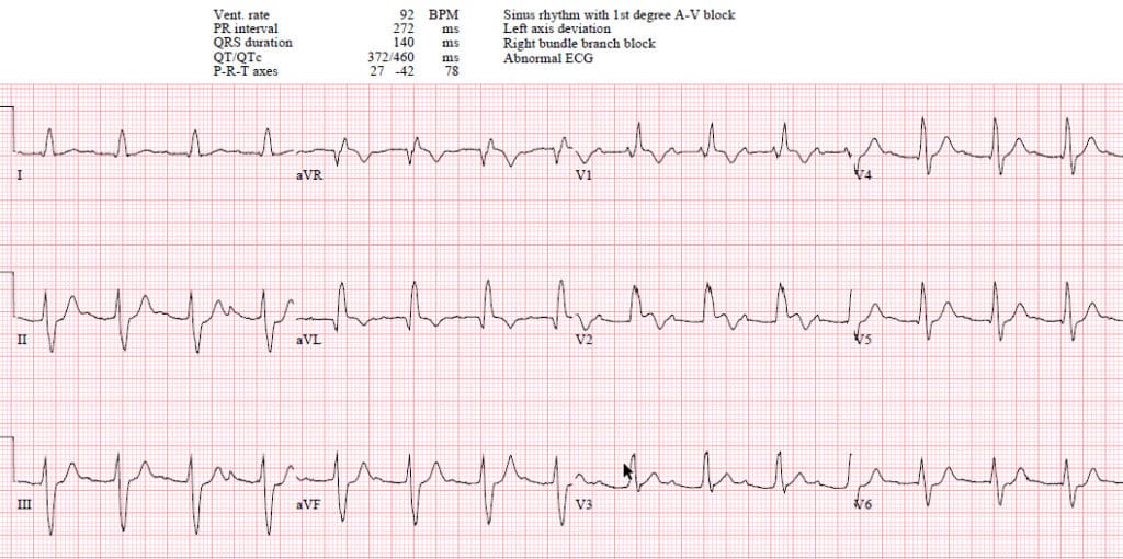 EM Cases | ECG cases 12: RBBB + Occlusion MI