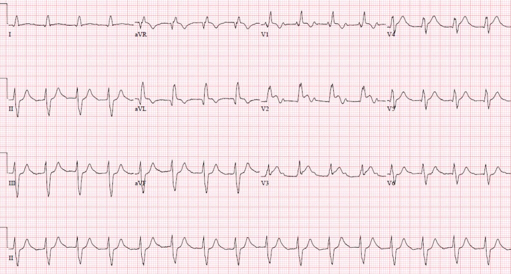 EM Cases | ECG cases 12: RBBB + Occlusion MI