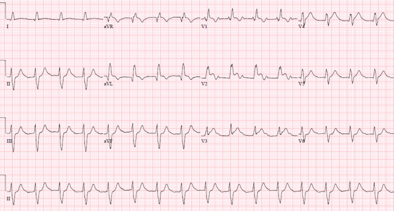 EM Cases | ECG cases 12: RBBB + Occlusion MI