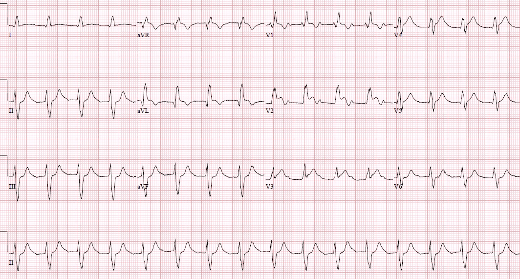 EM Cases | ECG cases 12: RBBB + Occlusion MI