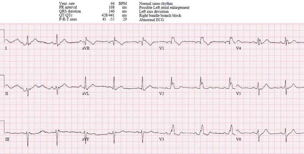 EM Cases | ECG cases 12: RBBB + Occlusion MI