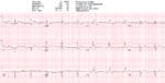 EM Cases | ECG cases 12: RBBB + Occlusion MI