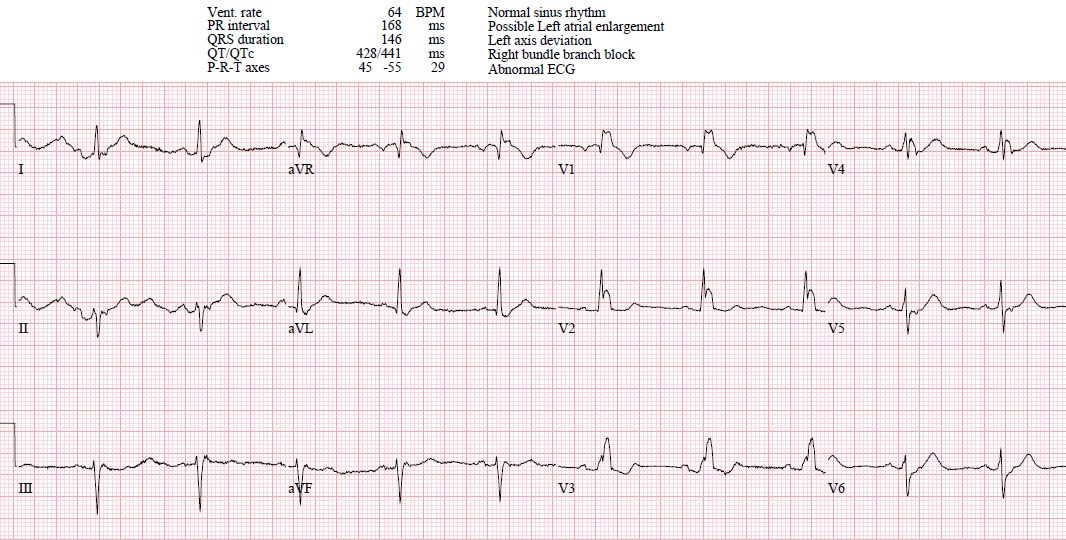 EM Cases | ECG cases 12: RBBB + Occlusion MI