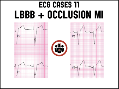 LBBB and Occlusion MI | ECG Cases | Emergency Medicine Cases