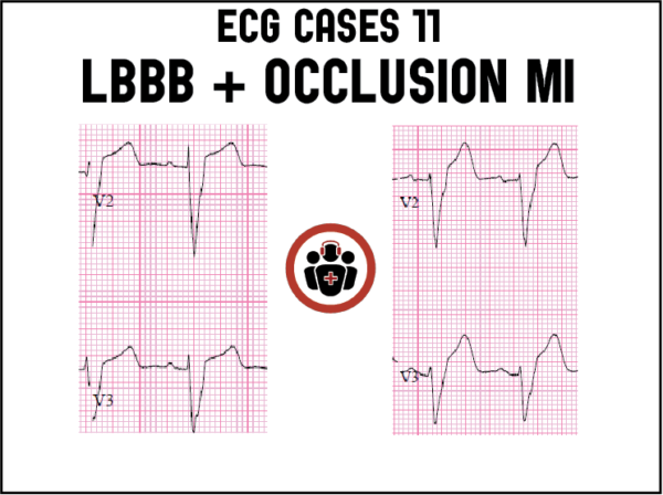 LBBB and Occlusion MI | ECG Cases | Emergency Medicine Cases