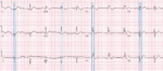 EM Cases | ECG cases 12: RBBB + Occlusion MI
