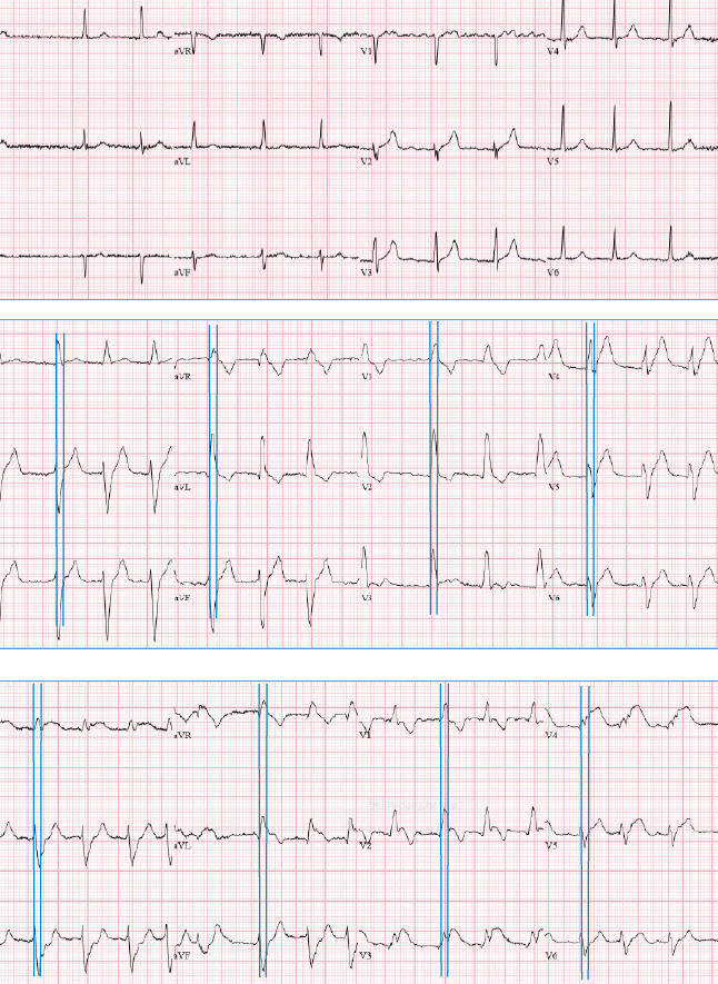 EM Cases | ECG cases 12: RBBB + Occlusion MI