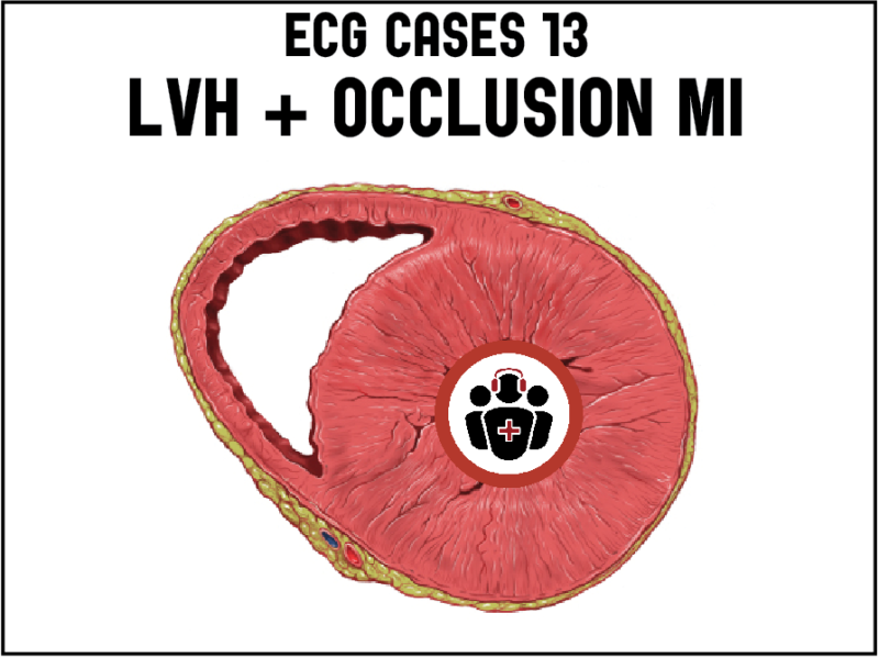 EM cases | ECG cases 13: LVH + occlusion MI