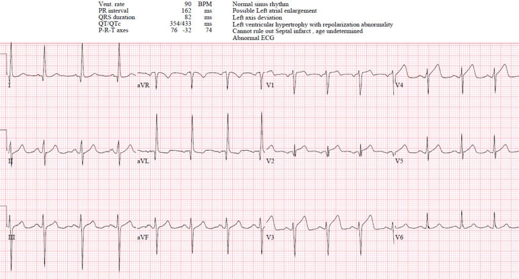 EM cases | ECG cases 13: LVH + occlusion MI