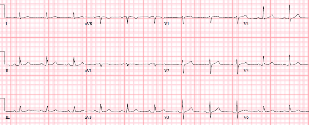 ECG Cases 14: Q-waves and Occlusion MI | EM Cases