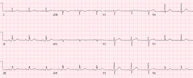 ECG Cases 14: Q-waves and Occlusion MI | EM Cases