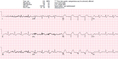 ECG Cases 14: Q-waves and Occlusion MI | EM Cases
