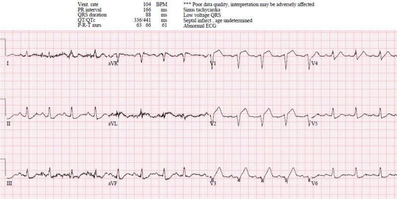 ECG Cases 14: Q-waves and Occlusion MI | EM Cases