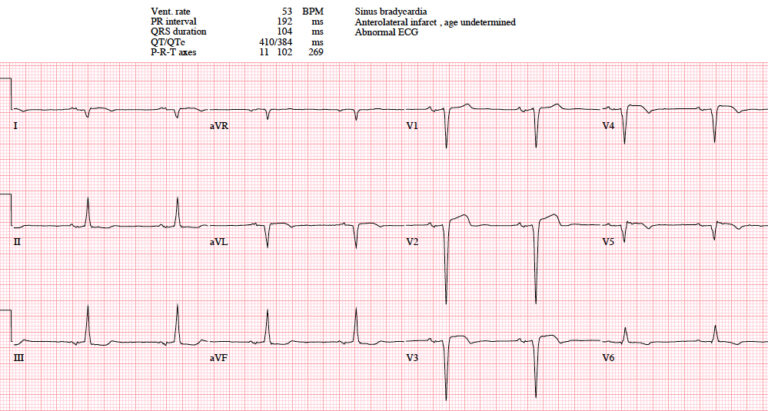 ECG Cases 14: Q-waves and Occlusion MI | EM Cases