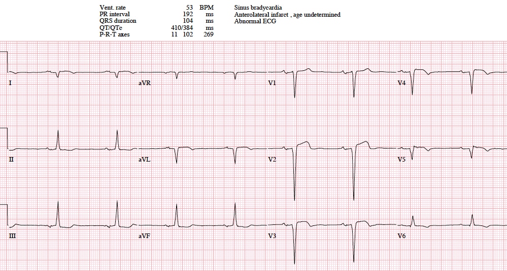 ECG Cases 14: Q-waves and Occlusion MI | EM Cases