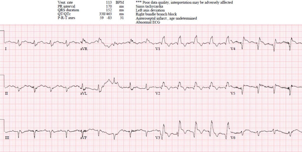ECG Cases 14: Q-waves and Occlusion MI | EM Cases