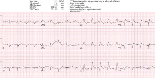 ECG Cases 14: Q-waves and Occlusion MI | EM Cases