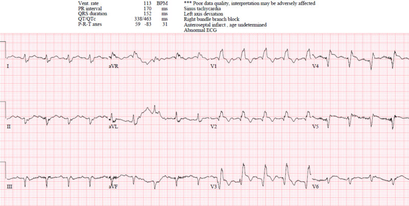 ECG Cases 14: Q-waves and Occlusion MI | EM Cases