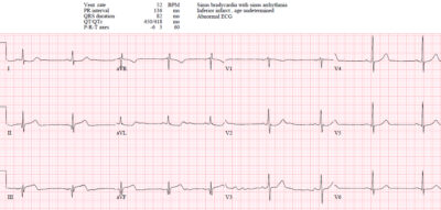 ECG Cases 14: Q-waves and Occlusion MI | EM Cases