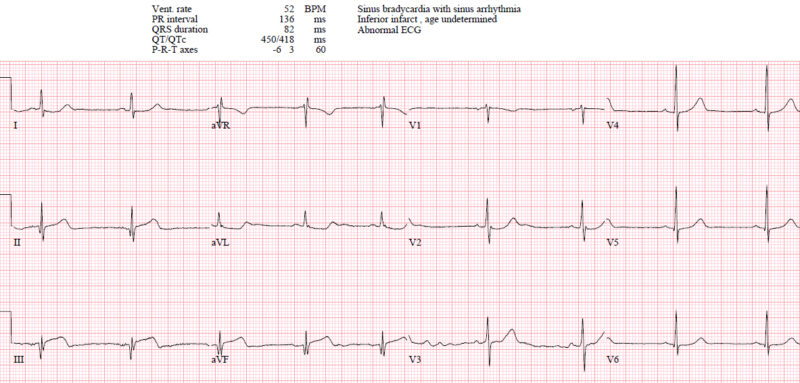 ECG Cases 14: Q-waves and Occlusion MI | EM Cases