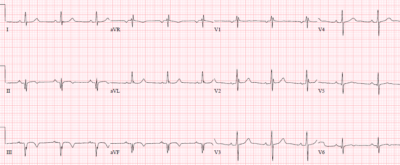 ECG Cases 14: Q-waves and Occlusion MI | EM Cases