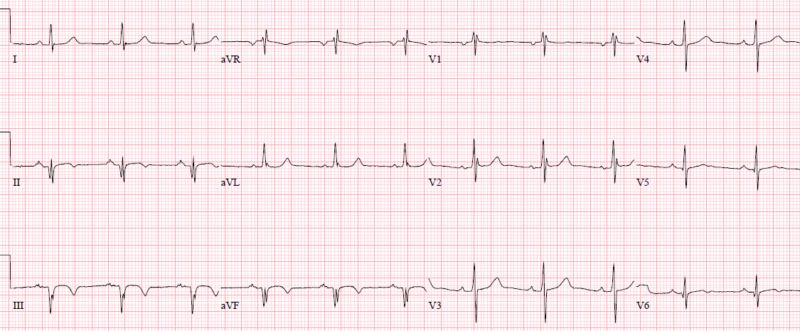 ECG Cases 14: Q-waves and Occlusion MI | EM Cases
