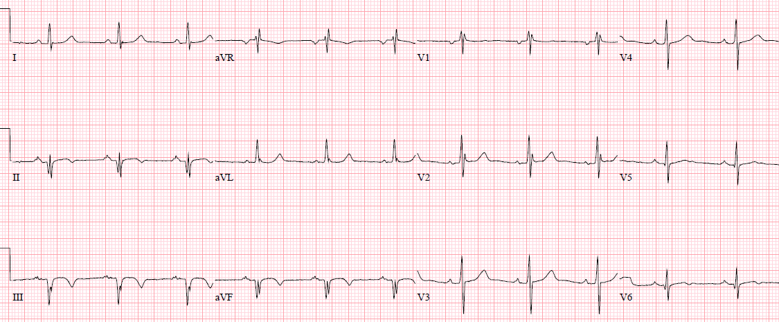ECG Cases 14: Q-waves and Occlusion MI | EM Cases