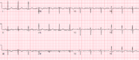 ECG Cases 14: Q-waves and Occlusion MI | EM Cases