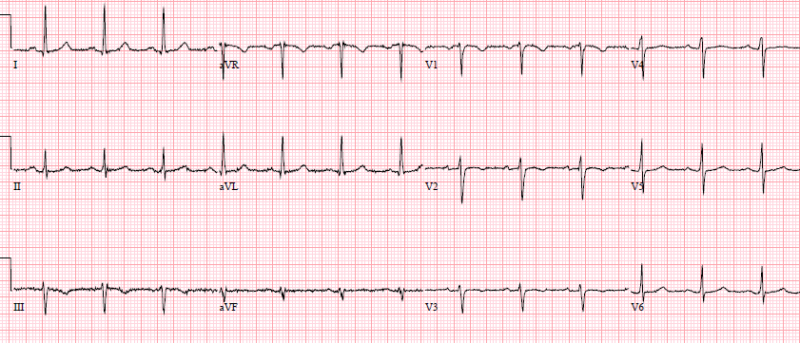ECG Cases 14: Q-waves and Occlusion MI | EM Cases