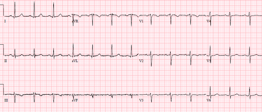 ECG Cases 14: Q-waves and Occlusion MI | EM Cases