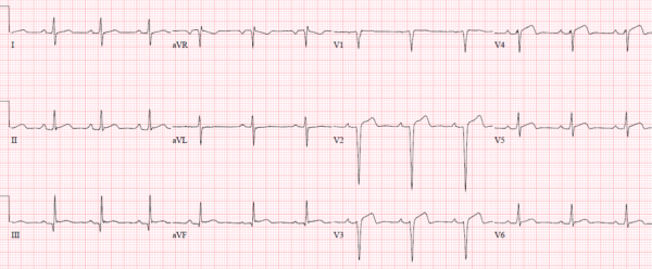 ECG Cases 14: Q-waves and Occlusion MI | EM Cases