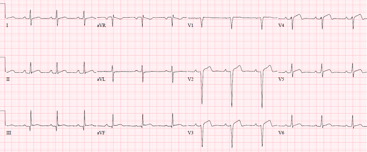 ECG Cases 14: Q-waves and Occlusion MI | EM Cases