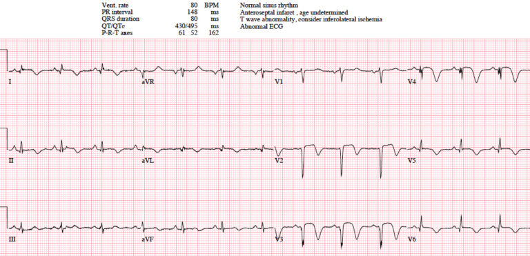 ECG Cases 14: Q-waves and Occlusion MI | EM Cases