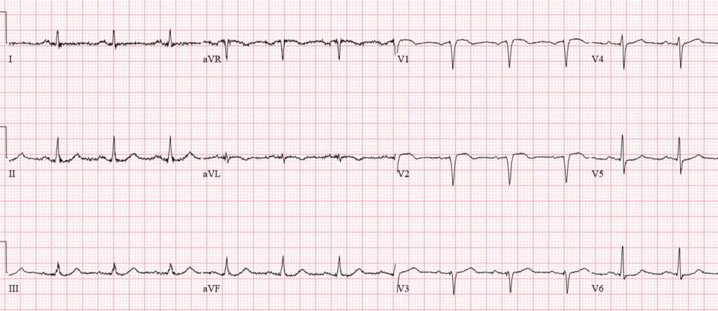 ECG Cases 14: Q-waves and Occlusion MI | EM Cases
