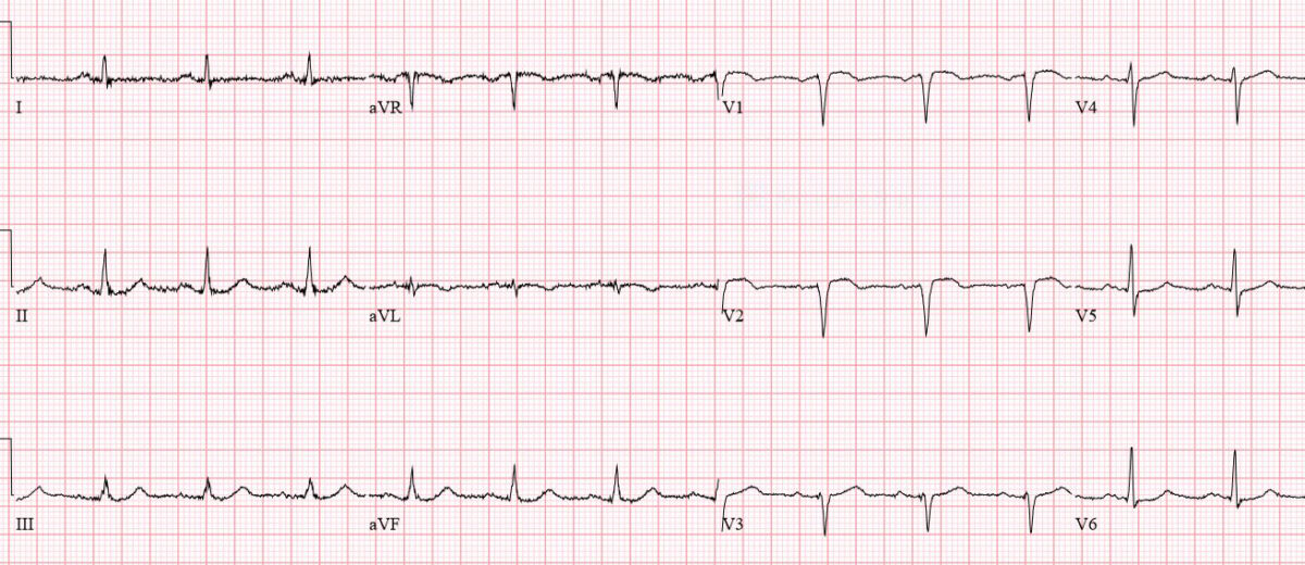 ECG Cases 14: Q-waves and Occlusion MI | EM Cases