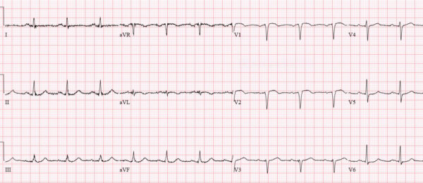 ECG Cases 14: Q-waves and Occlusion MI | EM Cases