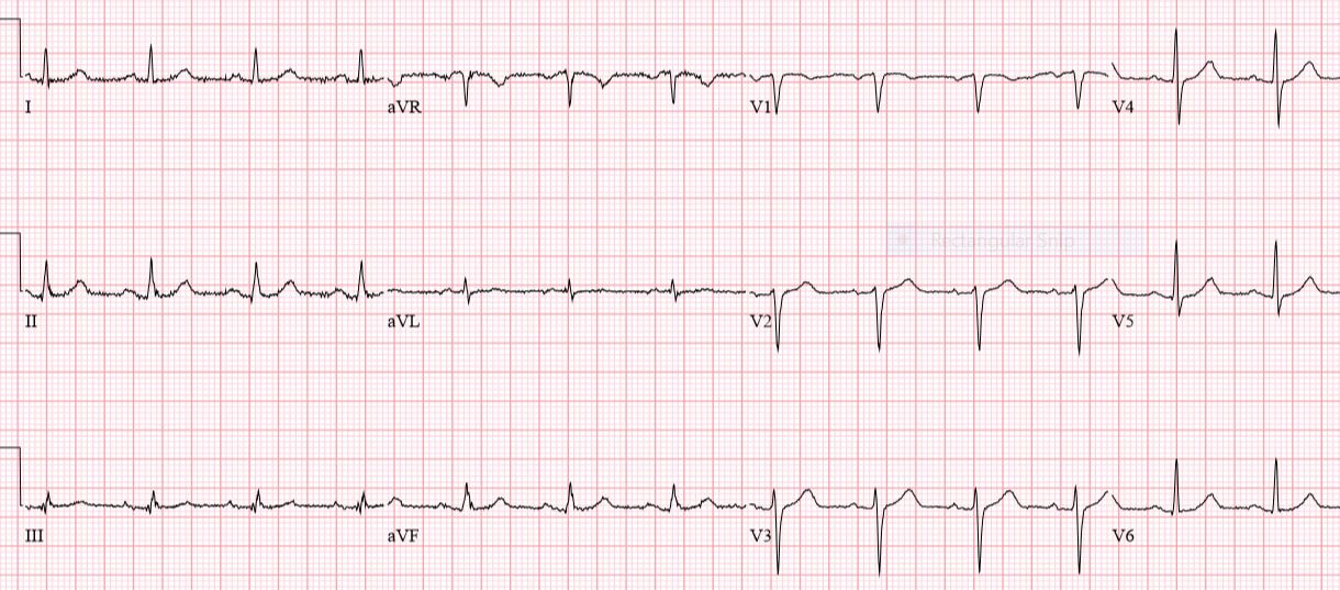 ECG Cases 14: Q-waves and Occlusion MI | EM Cases