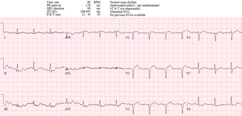 ECG Cases 14: Q-waves and Occlusion MI | EM Cases