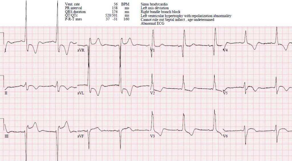 ECG Cases 15: Tall R Wave in V1 | Emergency Medicine Cases